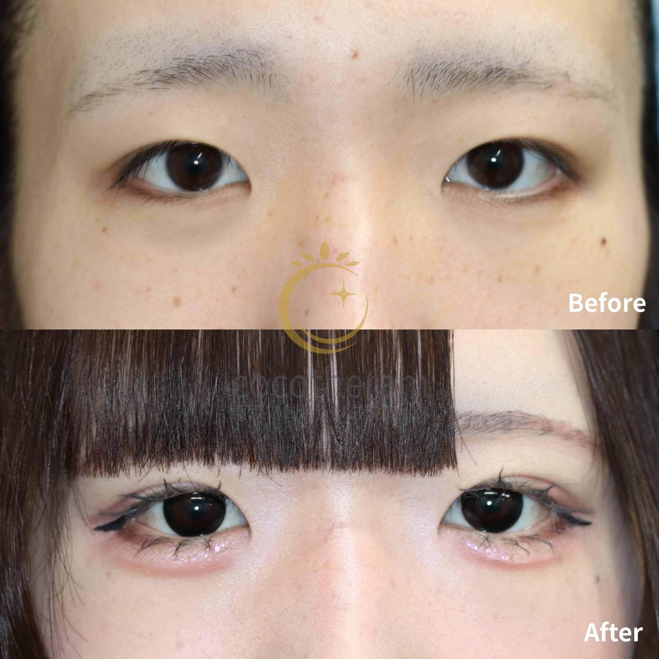 二重埋没法3点留め | コラム | 池袋駅徒歩5分の美容外科・皮膚科 | 東京ココセランクリニック